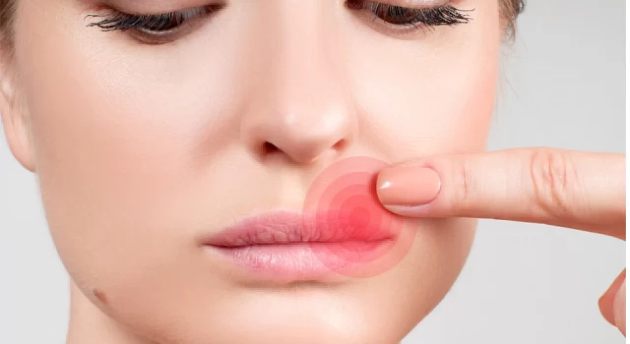 Uçuğa ne iyi gelir? Uçuk nasıl geçer? Neden olur? - Muhalif - Son ...